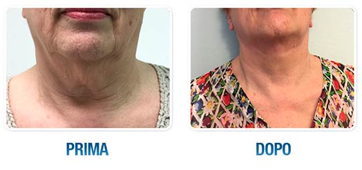 Lifting Collo - Chirurgia Plastica Milano: Chirurgo Plastico Estetico ...