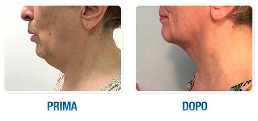 Lifting Collo - Chirurgia Plastica Milano: Chirurgo Plastico Estetico ...